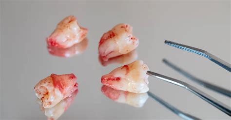 Dental Operculum And Its Effects On Oral Health Zenit Dent