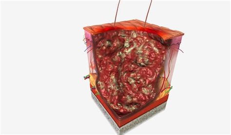 Premium Photo Pyoderma Gangrenosum Stage Iii3d