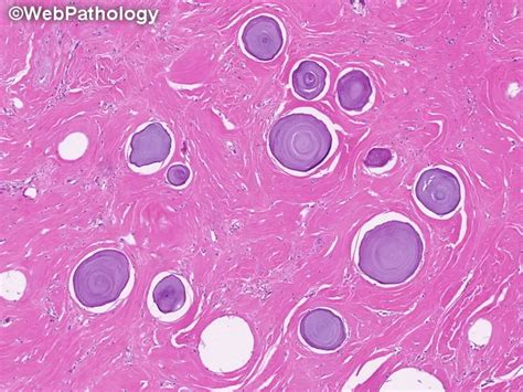 Calcifying Fibrous Tumor Differential Diagnosis