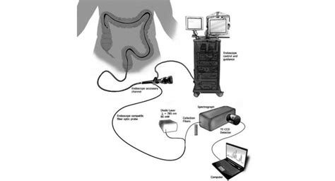 Sensor Integrates Ibd Detection Into Colonoscopy Procedure Medical