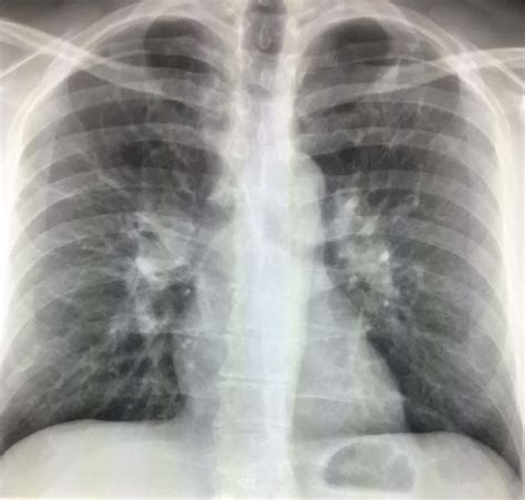 What Does Lung Apex Mean Radiology In Plain English