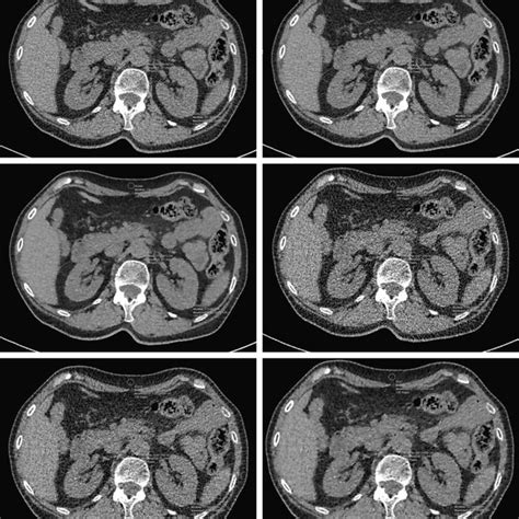 Méthode De Reconstruction Itérative Sinogram Affirmed Iterative Download Scientific Diagram