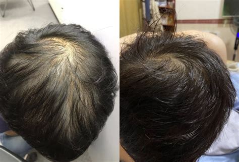 越拖越秃,脱发不仅要及时治疗,还要使用正确方法 知乎 越拖越秃,脱发不仅要及时治疗,还要使用正确方法 知乎
