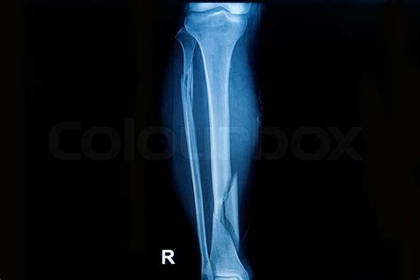 X Ray Image Show Fracture Both Bone Of Leg Stock Image Colourbox
