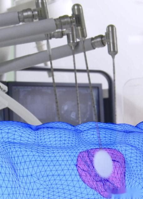 一文读懂肿瘤消融7大核心技术 知乎