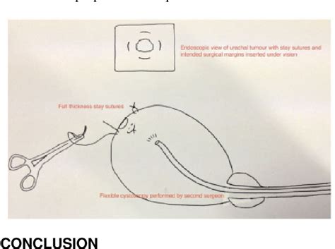 Figure 1 From Technique Of Excision Of Urachal Carcinoma During Partial Cystectomy Semantic