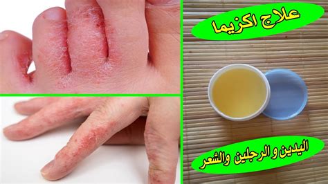 علاج الاكزيما بكل انواعها علاج نهائي من الاكزيما مجرب لايفوتك Youtube