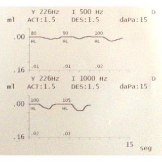 A Right Ear Tympanogram Was Consistent With A Type A Curve B Download Scientific Diagram