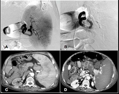 Case Report 1 A Arteriogram Before Embolization B Splenic Artery