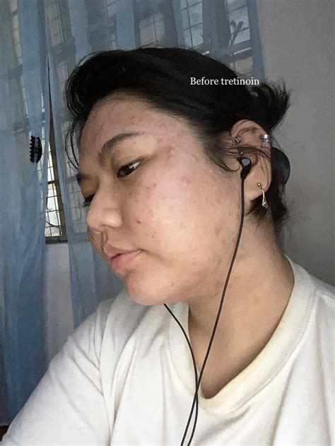 Just Finished 3rd Month On Tretinoin And Is Going On 4th Here Are Some