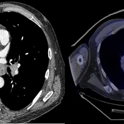 Mri Of The Brain A Dwi Revealing A 28 Cm Tubular Shaped