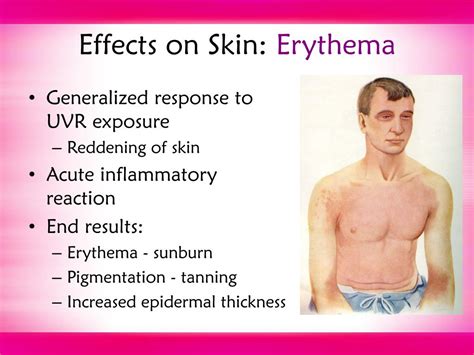 Ppt Ultraviolet Therapy Powerpoint Presentation Free Download Id