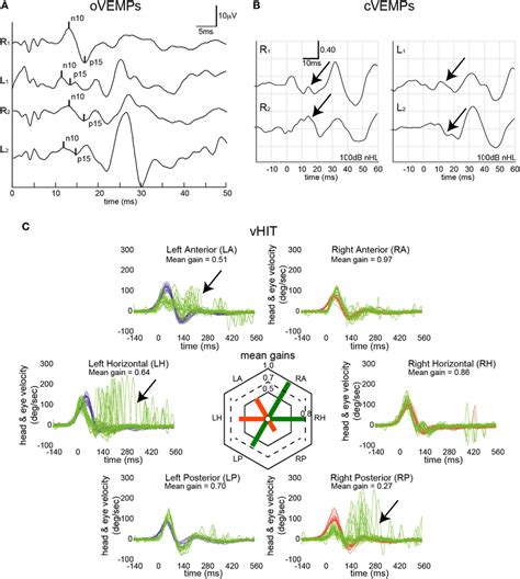 Vestibular Mapping In A Single Patient With Bilateral Menières Download Scientific Diagram