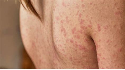What Does Scleroderma Rash Look Like Torrinomedica