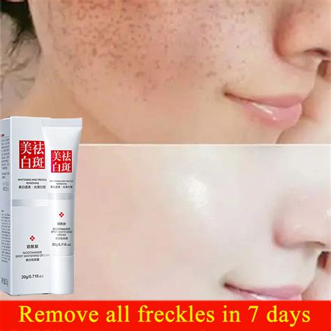 Melasma Cream Original Pekas Remover Cream Original Freckle Remover