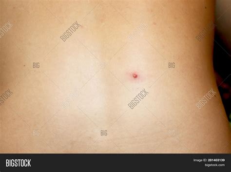 Close Pimple On Back Image Photo Free Trial Bigstock