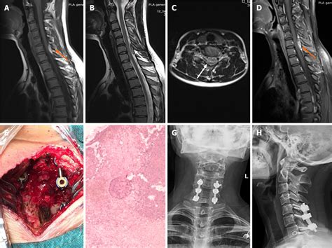 Epidural Hematoma Spinal Cord Compression Clinical Management For