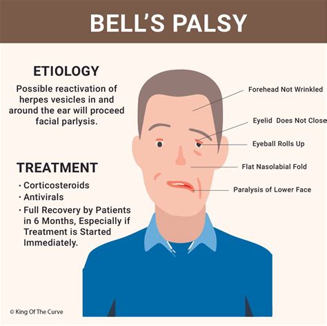 Bells Palsy Symptoms Causes And Treatment Guidelines — King Of The