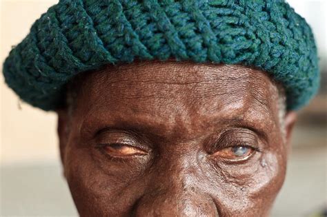 Global Onchocerciasis Network For Elimination Gone