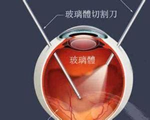 玻璃体混浊 搜狗百科