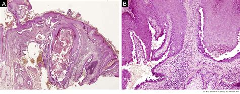 Recalcitrant Vegetative And Nodular Scalp Lesions On The Vertex In Pemphigus Patients An