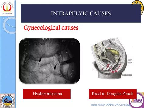 Extra Spinal Causes Of Sciatica And A Causes Algorithm Ppt