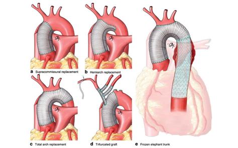 Aortic Surgery The Baird Institute