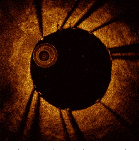 Figure 9 From Automatic Three Dimensional Registration Of Intravascular