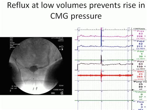 It All Together Practical Advice On Clinical Urodynamics Abdominal Key