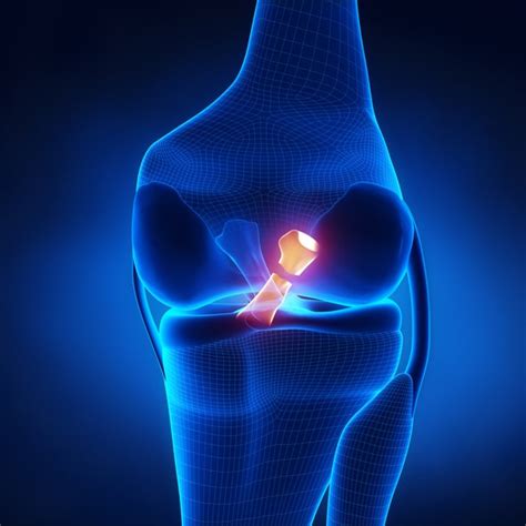 Acl Tears Vs Pcl Tears Colorado Center Of Orthopaedic Excellence