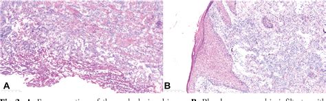 Figure 2 From Cutaneous Angiosarcoma Of The Scalp In A Pediatric