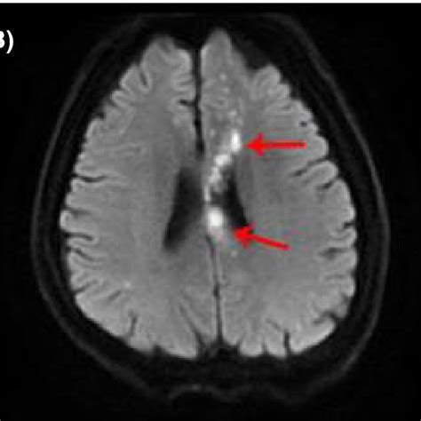 Mri Images Showing Acute Cerebral Infarction In Multiple Sites Of The Download Scientific