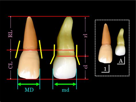 Morphological Differences Between Deciduous Teeth And Their Successors Download Scientific