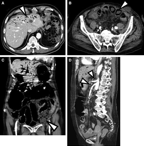 [pdf] Nonocclusive Mesenteric Ischemia Is A Potentially Lethal Complication Just After Stroke