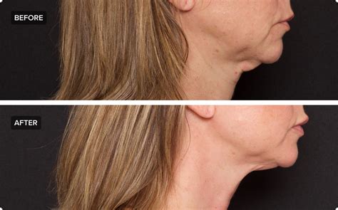 Eyebrow Threading Gone Wrong