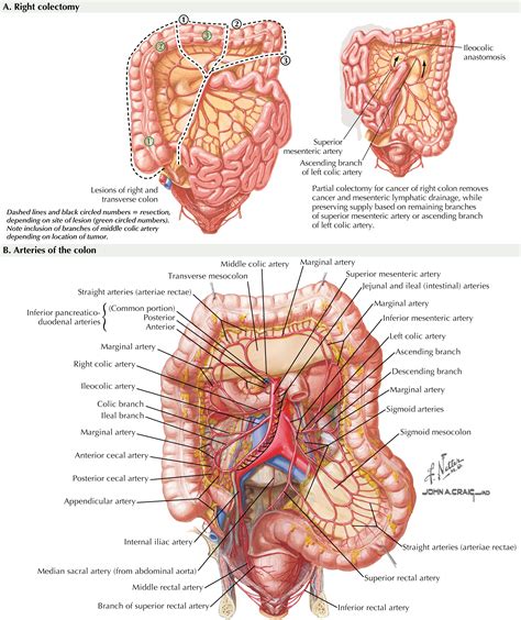 Right Colectomy Clinical Tree