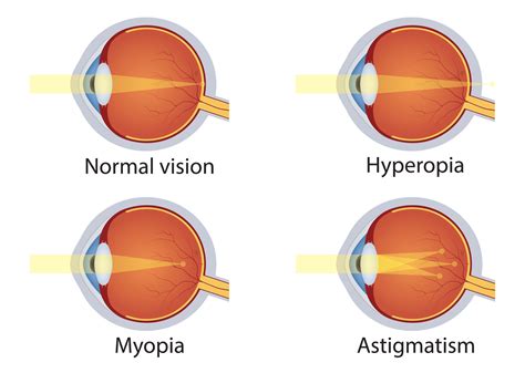 What Is An Eye Refraction Eye Associates Of New Mexico
