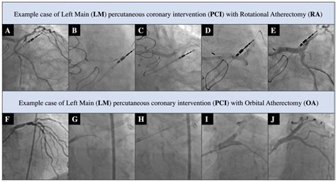 Figure 1 From Comparison Of Orbital Atherectomy And Rotational