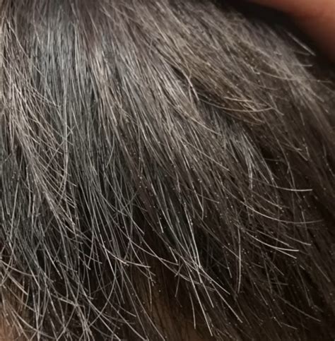 머리카락에 하얀 알갱이 지식in