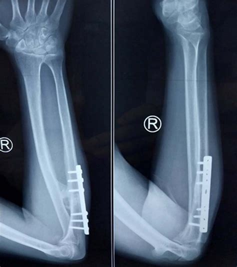 Plain X Ray Of Right Forearm Showing United Proximal Ulna Fracture With Download Scientific