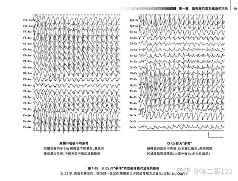 小儿脑电图图谱（已做目录书签） 刘晓燕 知乎