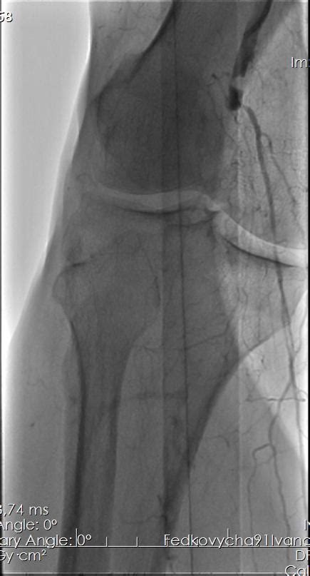 Oleksiy Gudz On Linkedin Nice Supera Stenting