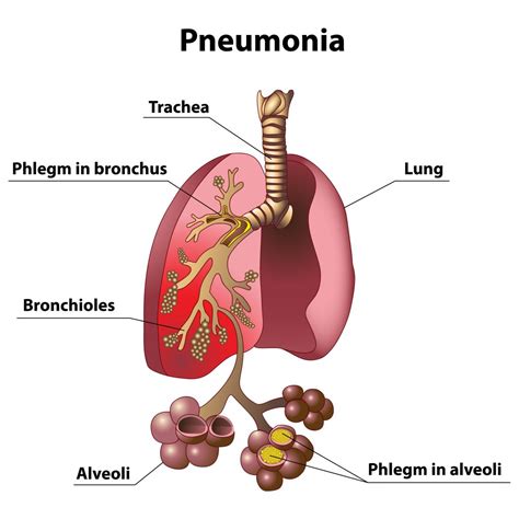 Pneumonia In Same Area Of Lung At Conrad Martinez Blog