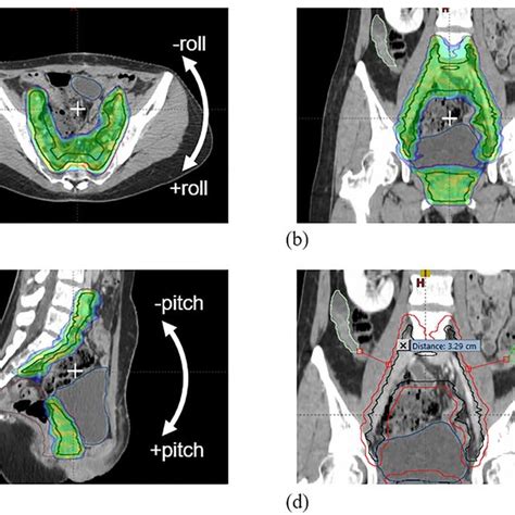 A B And C Treatment Planning During Postoperative Vmat For Download Scientific Diagram