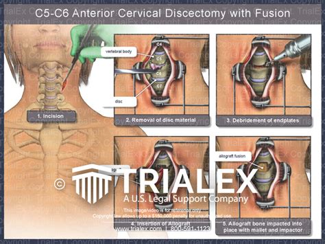 C5 C6 Anterior Cervical Discectomy With Fusion