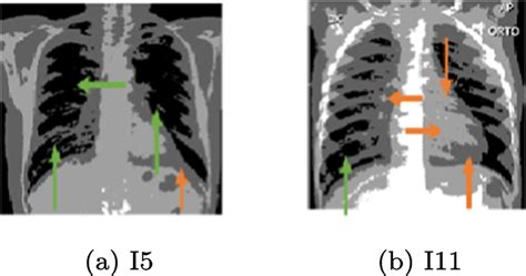 Illustration Of Pneumonia Affected And Unaffected Areas In Cxr Images