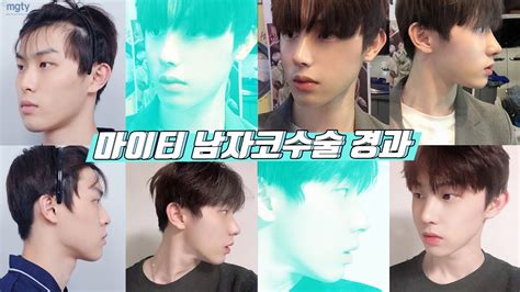 남자코수술 경과 마이티성형외과 Youtube
