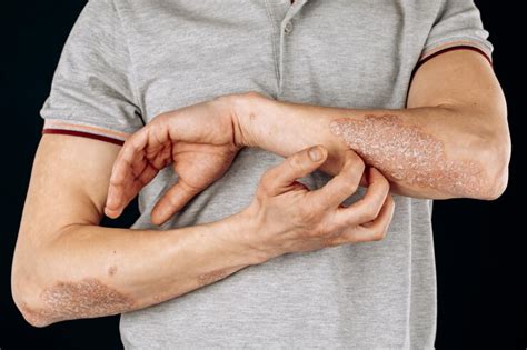 Premium Photo Acute Psoriasis On The Elbows Is An Autoimmune Incurable Dermatological Skin