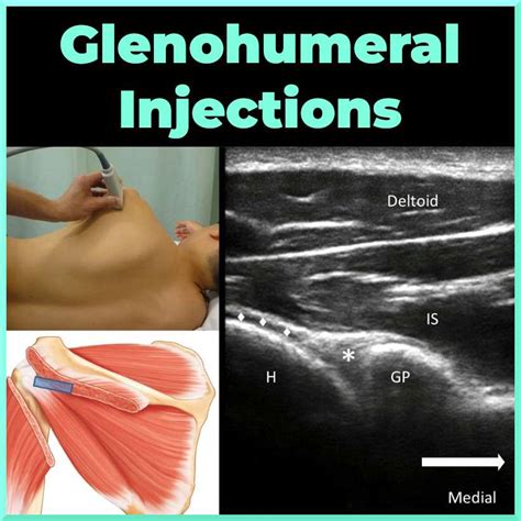 Ultrasound Guided Glenohumeral Joint Injection Sports Medicine Review