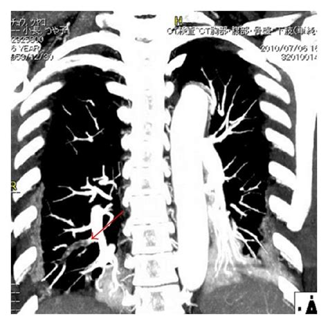 A Contrast Enhanced Computed Tomography Revealed The Presence Of Download Scientific Diagram